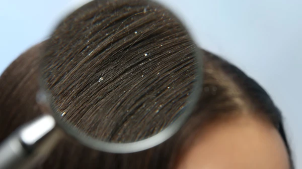 How long does it take to get rid of dandruff?